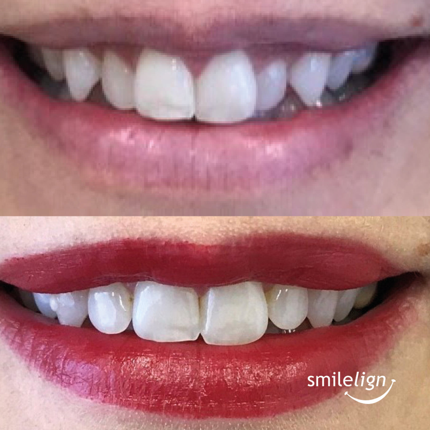 Smilelign Clear Aligners – S4S Dental